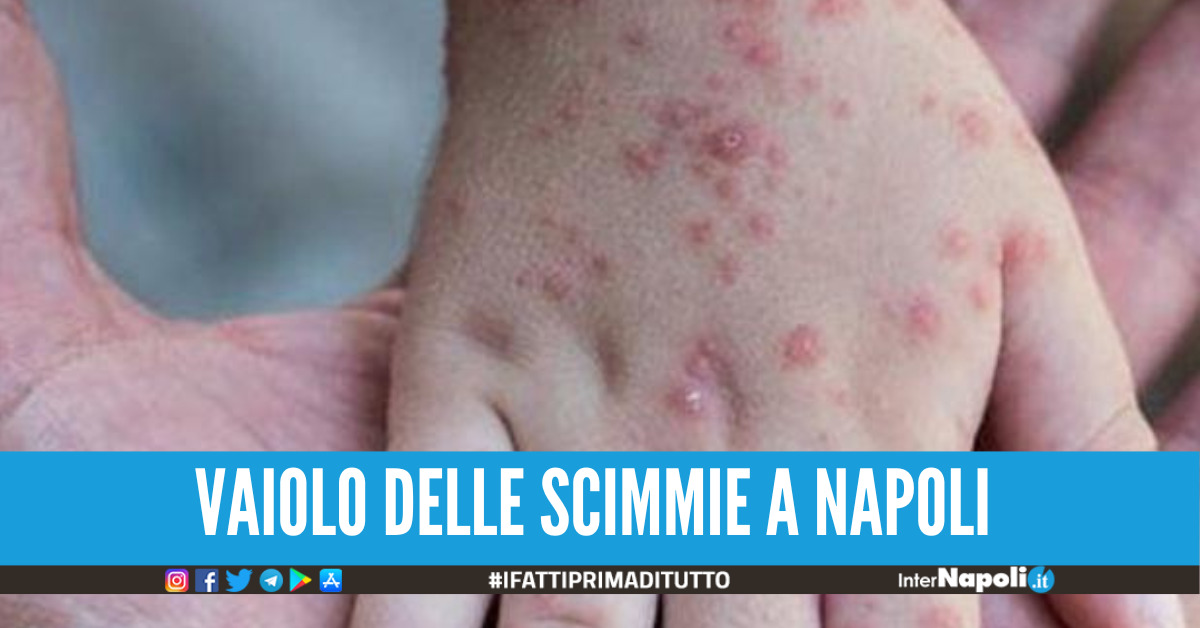 Vaiolo delle scimmie, primo caso a Napoli: contagiato 40enne di ... Vaiolo delle scimmie, primo caso a Napoli: contagiato 40enne di ...