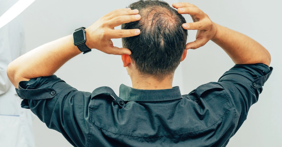 La patch cutanea, un rimedio funzionale per la calvizie | Internapoli.it